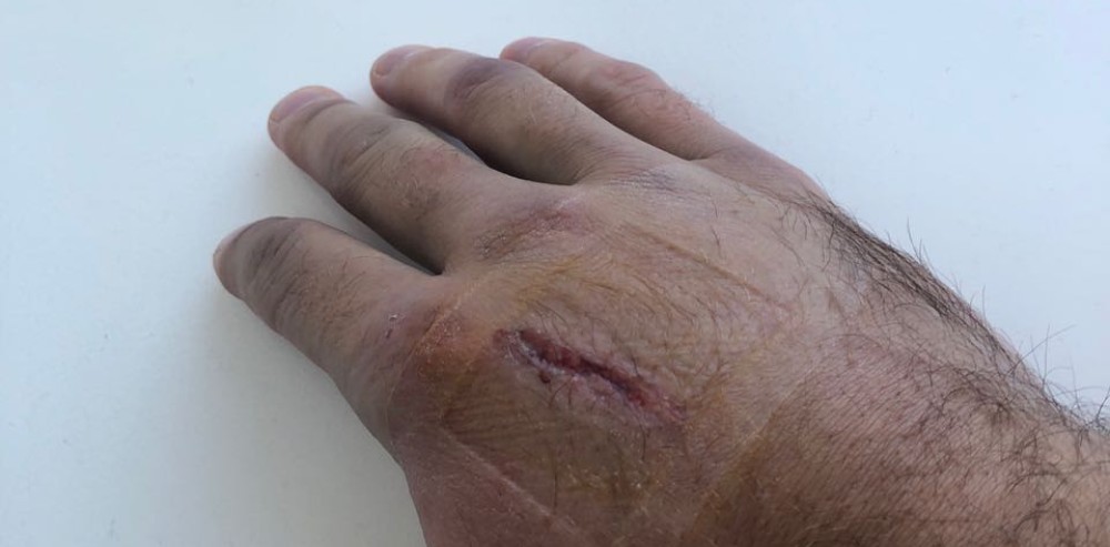 De Benedictis mostró cómo está la mano lastimada | Carburando